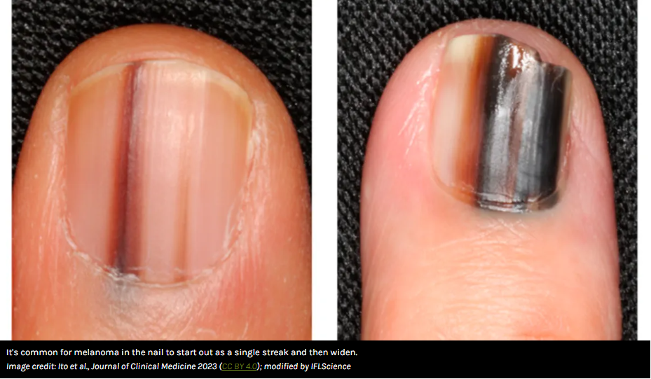 Ren Ecosystem. What Can Nail Changes Say About Our Health? Here's What ...