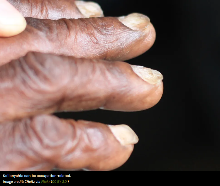 Ren Ecosystem. What Can Nail Changes Say About Our Health? Here's What ...